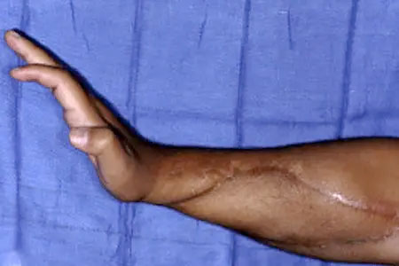 Scars : Page 2 of 5 : Dermatology and Skin Surgery Center - North Carolina