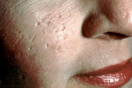 Scars : Page 2 of 5 : Dermatology and Skin Surgery Center - North Carolina