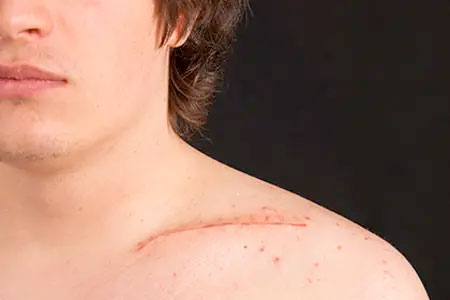 Scars : Page 2 of 5 : Dermatology and Skin Surgery Center - North Carolina