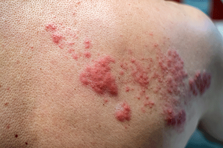 Shingles: How to reduce your risk : Page 2 of 5 : Dermatology and Skin ...