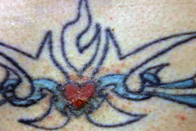 Tattoos: 7 unexpected skin reactions and what to do about them ...