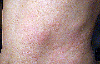 Hives : Page 6 of 7 : Dermatology and Skin Surgery Center - North Carolina