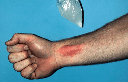 Hives : Page 7 of 7 : Dermatology and Skin Surgery Center - North Carolina